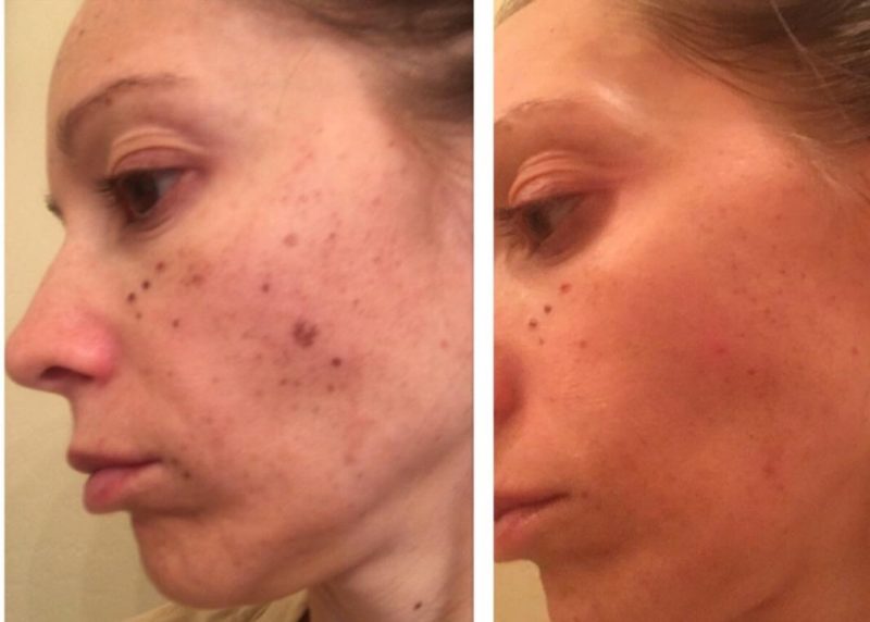 Skin Treatment Experts in Tempe | NEOS Med Spa of Arizona